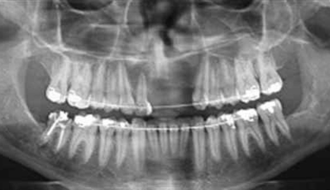 Cistos: Saúde bucal - Ceddro Radiologia e Tomografia digital - Integra ...